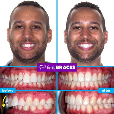 Severe Overbite Before And After Braces