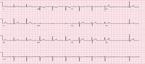 EKG On Admission Showing Second Degree Mobitz Type 1 AV Block
