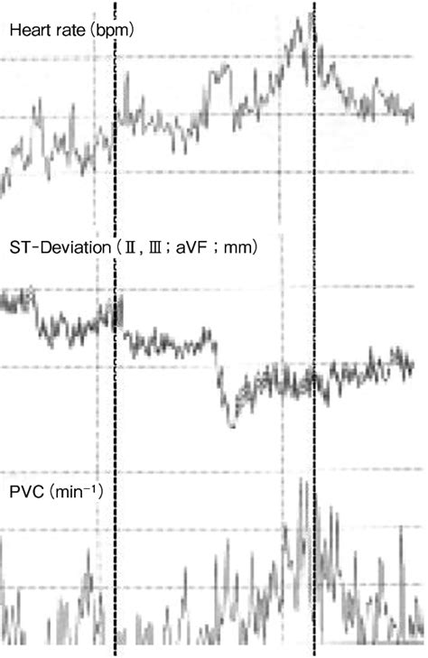 Continuous Recordings Of Heart Rate Top Stsegment Deviation Middle Download Scientific