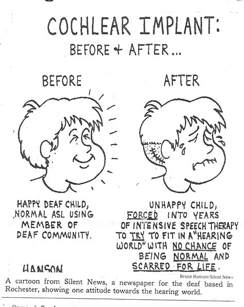 Pros And Cons Of A Cochlear Implant The Only Way Is Up Artofit