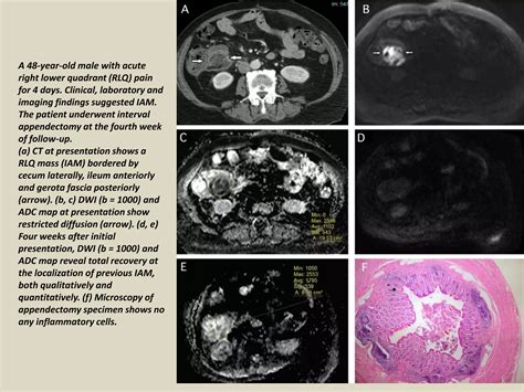 Presentation Radiological Application Of Diffusion Weighted Images In Abdome And Pelvic