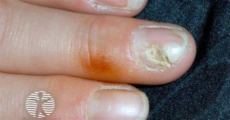 Dermnet® Psoriatic Nail Dystrophy Image