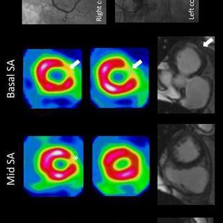 Interpretation Of ABPi Download Table