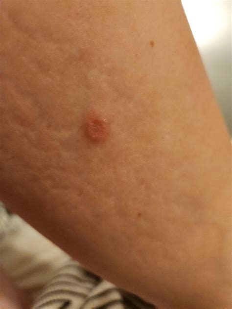 Ringworm Vs Staphimpetigo Rdermatologyquestions