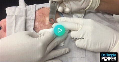 The Biggest Dilated Pore Of Winer  On Imgur