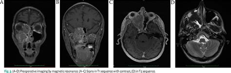 Figure 3 From Juvenile Psammomatoid Ossifying Fibroma Case Report