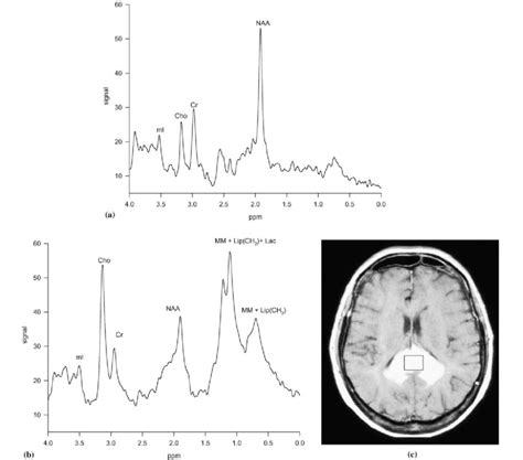 Proton Spectroscopy In Pcnsl A Healthy Volunteer Spectrum With