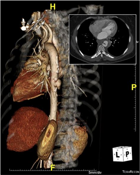 Tertiary Syphilis Aorta