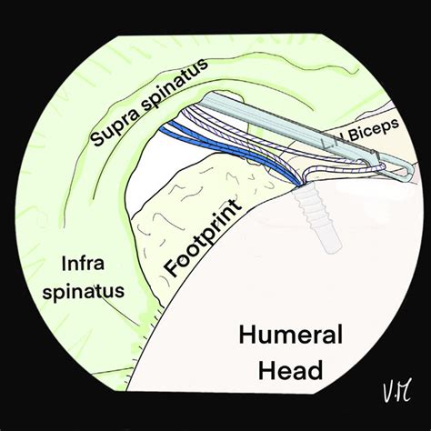 Drawing Of An Arthroscopic Subacromial View From The Posterior Portal Download Scientific
