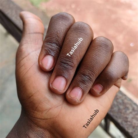 Understanding Onycholysis Of The Nail Causes Symptoms And Treatment Tasiahub