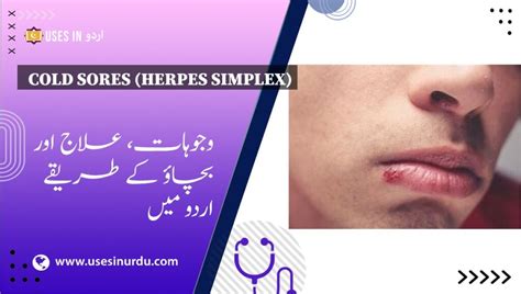 Cold Sores Herpes Simplex Uses In Urdu