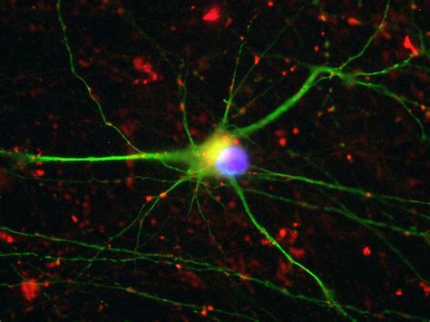 Bachelor And Master Assignments Automatic Eeg Source Reconstruction Of Epilepsy In The Clinic