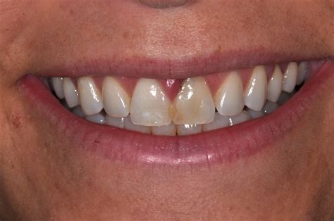 Stony Brook Dental Implants Dentist Stony Brook Dental Implants Dentistry