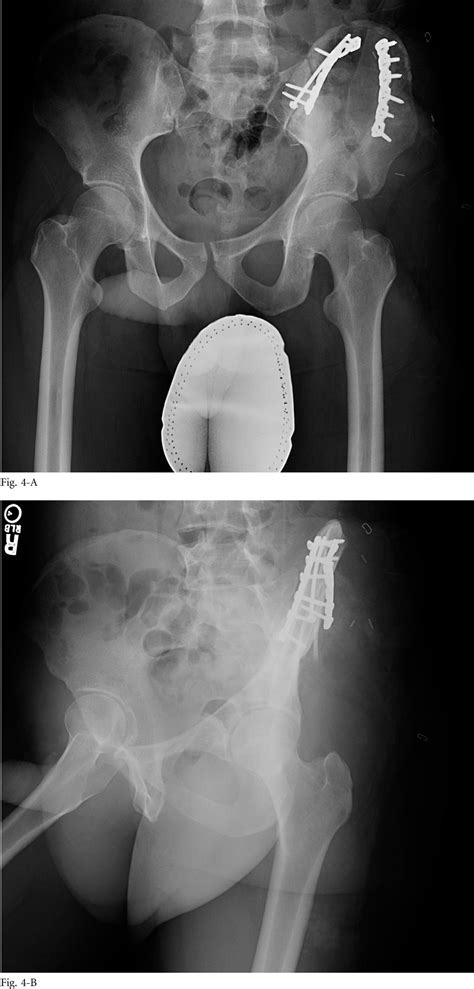 Fracture Of Iliac Crest Semantic Scholar