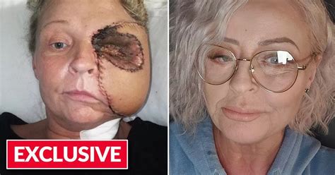 Flesh Eating Bug Ate My Face And Nearly Killed Me But It Helped Me