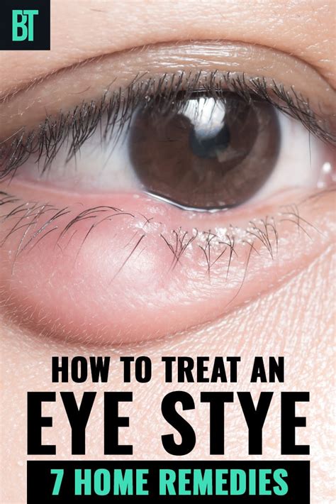 Eye Stye Causes And 7 Best Home Remedies To Treat Eye Stye