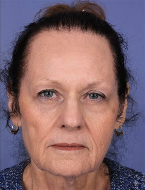 Facelift Before And After 09 Core Plastic Surgery