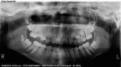 Teeth Segmentation On Dental X Ray Images Dataset Ninja