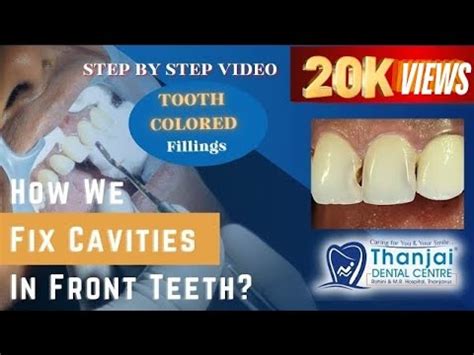 How To Fix Cavities Between Front Teeth Composite Filling Video How