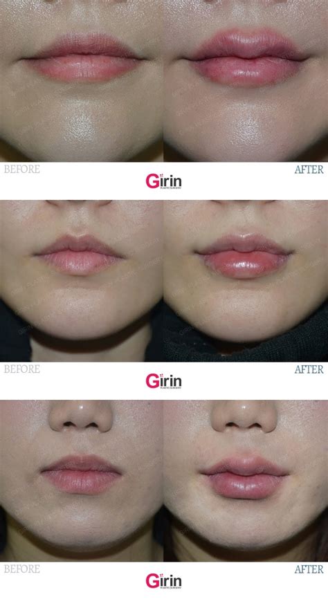 Lips Augmentation And Mouth Corner Lift Filler Before And After