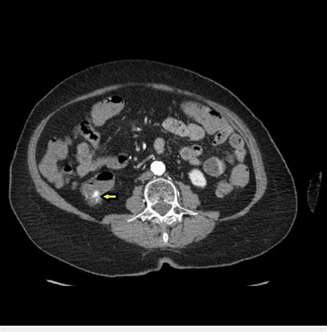 Ct Of The Abdomen Showing Active Bleeding In The Proximal Ascending