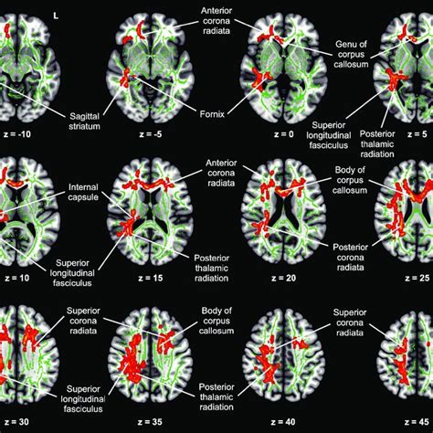 White Matter Regions That Showed Significantly Lower Fa Values In