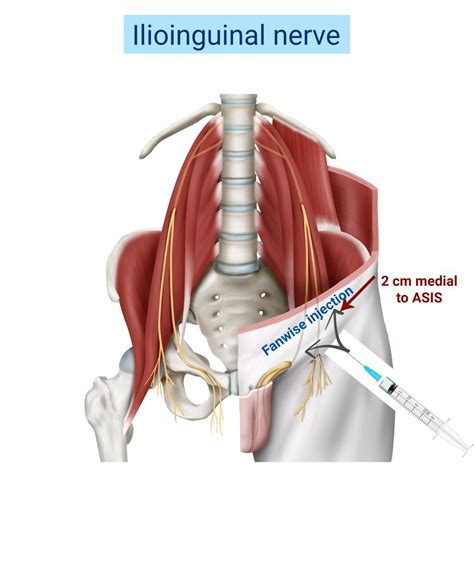 Ilioinguinal Nerve Block Assic Education