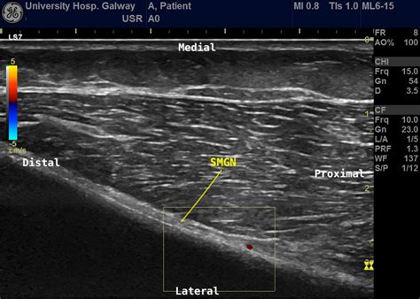 Ultrasound Guided Genitofemoral Nerve Block Agaclip