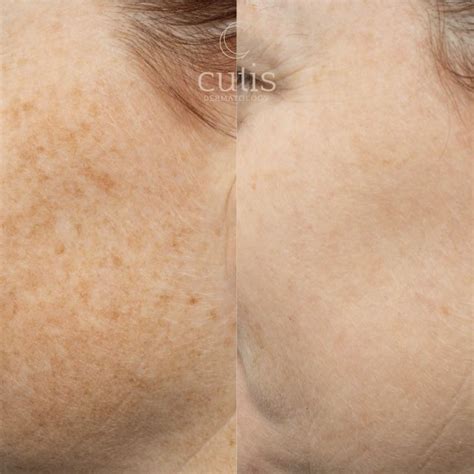 Ipl Face Cutis Dermatology