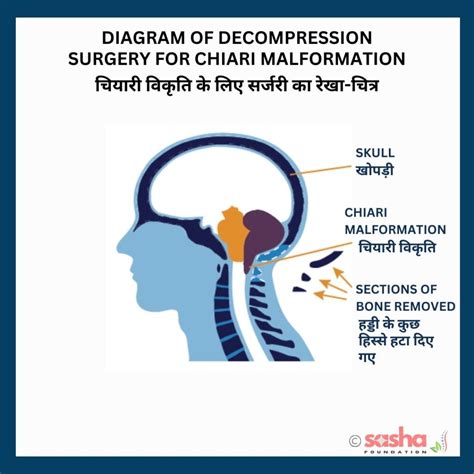 What Is Chiari Malformation How Does It Affect Sb People