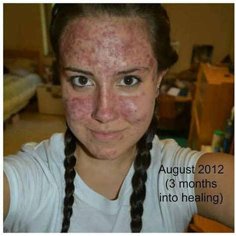 Pyoderma Faciale Rosacea Fulminans Pfrf
