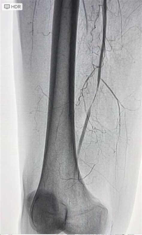 Tight Lession On The Sfa For Patient With Clti Rutherford 6 Dr Dr