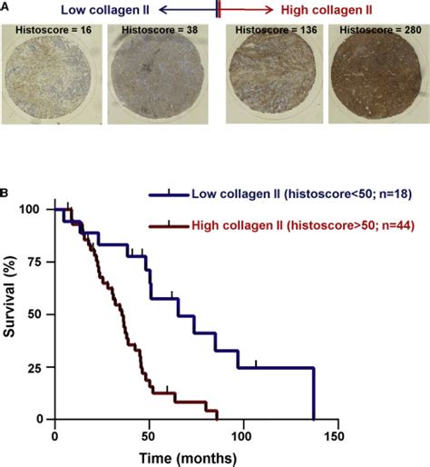 Type Ii Collagen Expression Predicts Poor Prognosis In Ovarian Cancer
