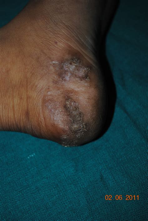 Tuberculosis Cutaneous Dermatology Advisor
