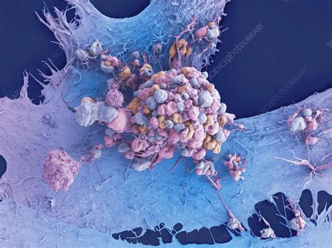 Cervical Cancer Cell Apoptosis Sem Stock Image C0610494 Science
