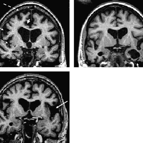 Mri Findings In Cjd Ab A Patient With Probable Variant Cjd And Download Scientific Diagram