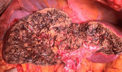 Central Hepatectomy For Liver Metastases From Colon Cancer Download