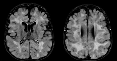 Pediatric Neurology Jacobsen Syndrome