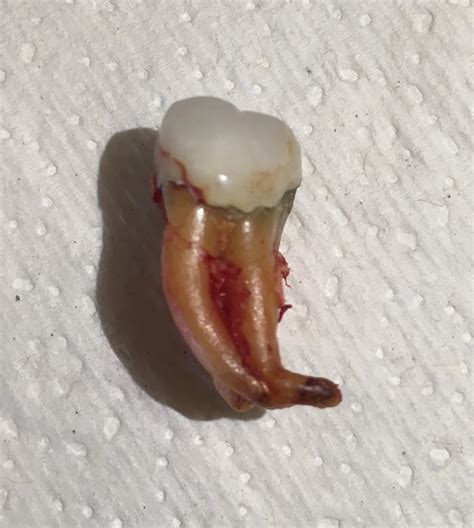 Blog Its Like Pulling Teeth