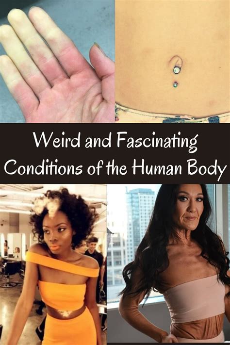Weird And Fascinating Conditions Of The Human Body Human Human Body Fascinating