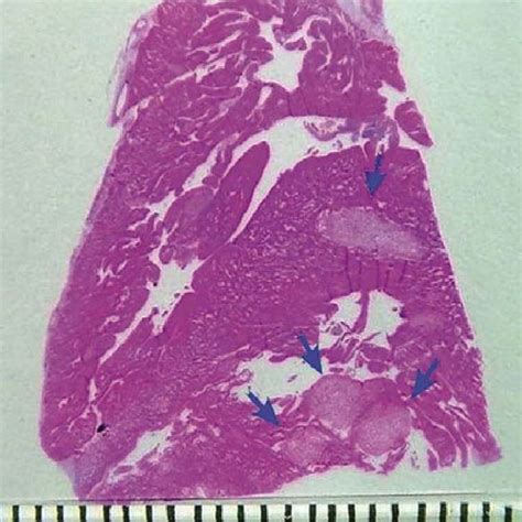 Multiple Nodular Lesions Of Varying Sizes Arrows Within The Download Scientific Diagram