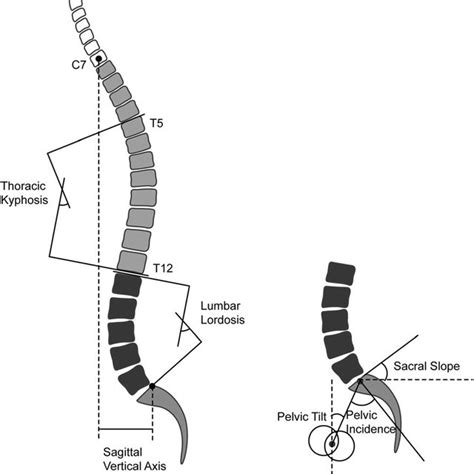 The Four Types Of The Roussouly Sagittal Classification The Shape Of