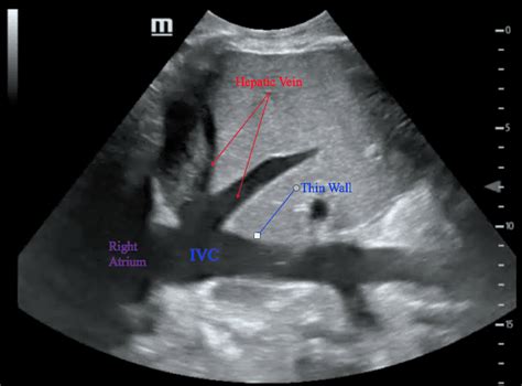 Internal Medicine Point Of Care Ultrasound Impocus