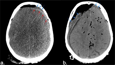 Acoexistence Of Antemortem Subdural Red Arrows And Postmortem Heat