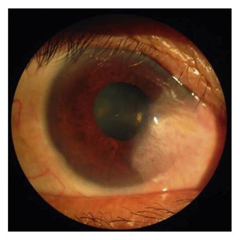 Conjunctival Manifestations Before During And After The Operation Download Scientific