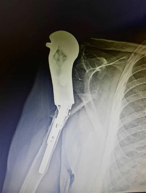 One Of The Stranger Shoulder Replacements Ive Seen Supposedly From