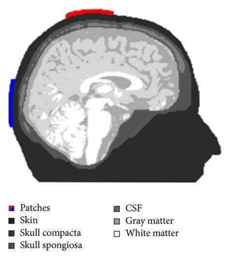 a anisotropic finite element model for simulations of intracranial