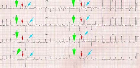 Ashman Phenomenon Ecg Book