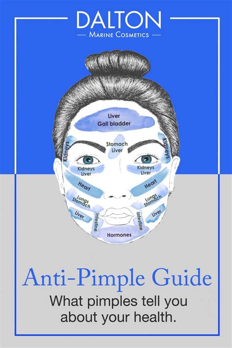 Hormonal Acne Artofit