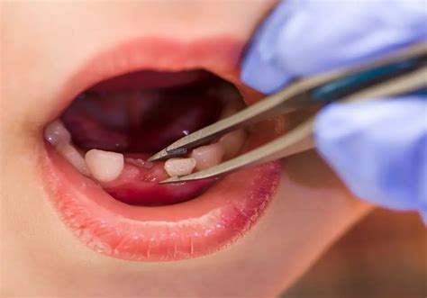 How Can I Pull My Own Tooth Fast Ultimate Guide
